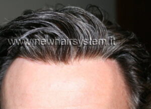 Soluzioni contro la caduta dei capelli e calvizie - New Hair System